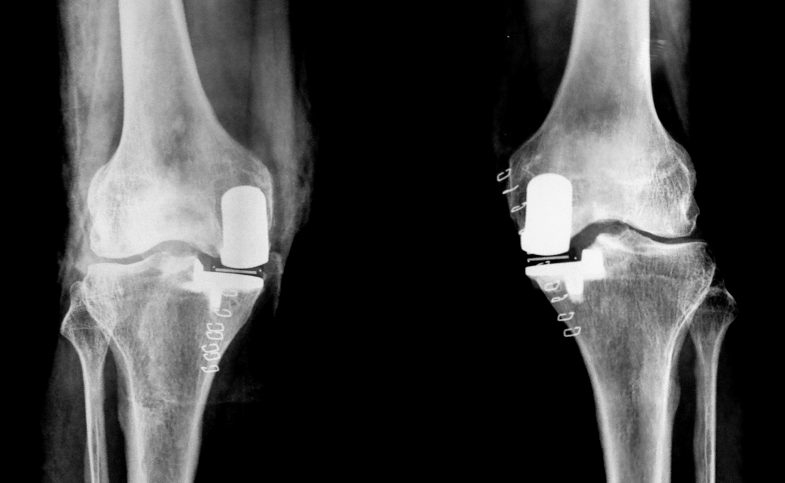 Knee Replacement UDAI OMNI HOSPITALS Knee Replacement UDAI OMNI HOSPITALS