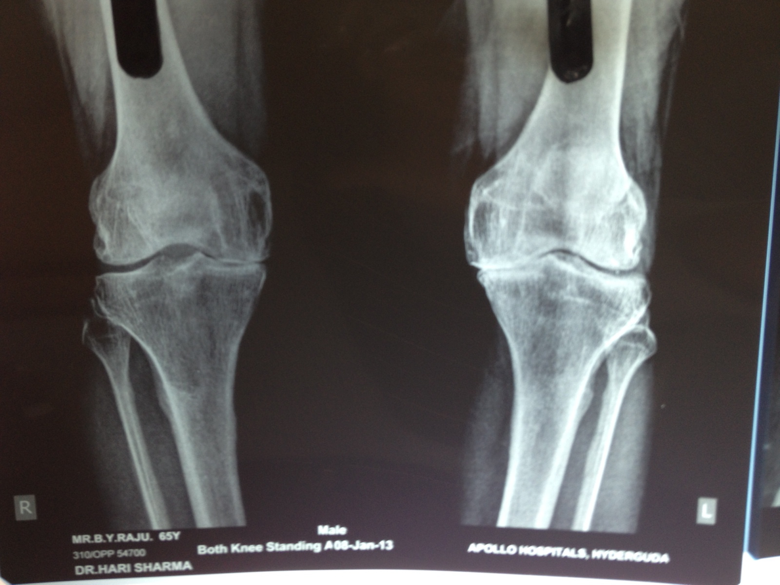 Knee Replacement UDAI OMNI HOSPITALS Knee Replacement UDAI OMNI HOSPITALS